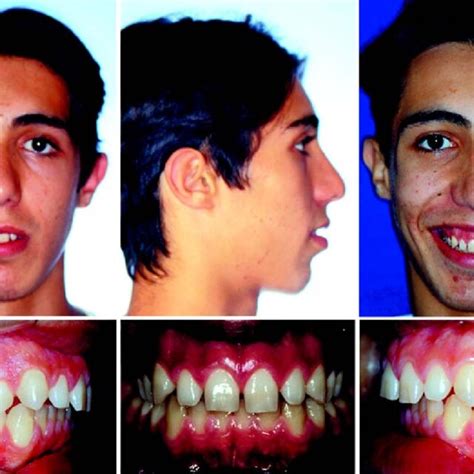 Pdf An Orthodontic Surgical Approach To Class Ii Subdivision