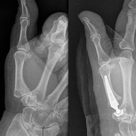 Pre And Post Operative Radiographs Download Scientific Diagram