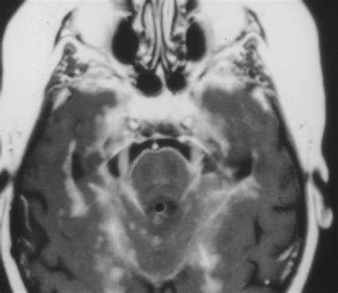 Trigeminal Nerve Anatomy Illustrated Using Examples Of Abnormalities Ajr