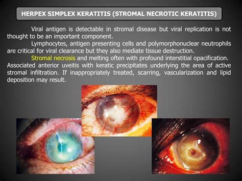 Ppt Cornea Anatomy And Diseases Diagnosis And Treatment Powerpoint