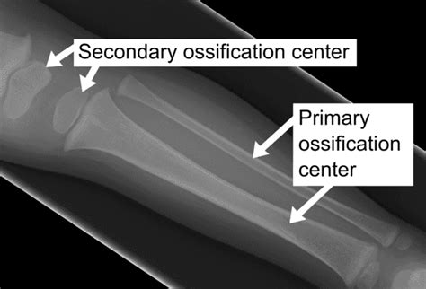 Ossification Center Wikiwand