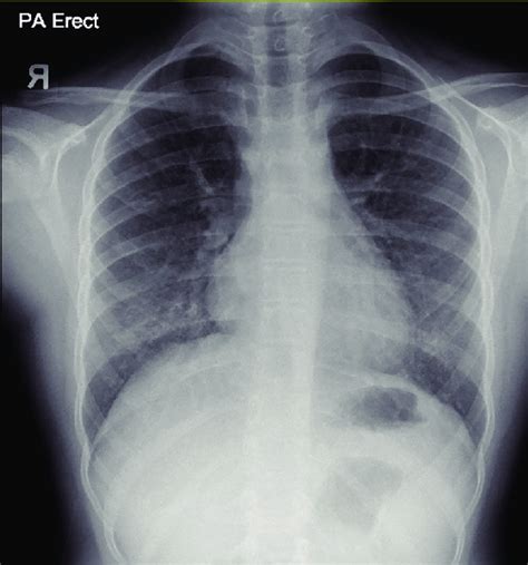 Chest X Ray Nine Months Post Discharge Showed Persistent Fine Reticular Download Scientific
