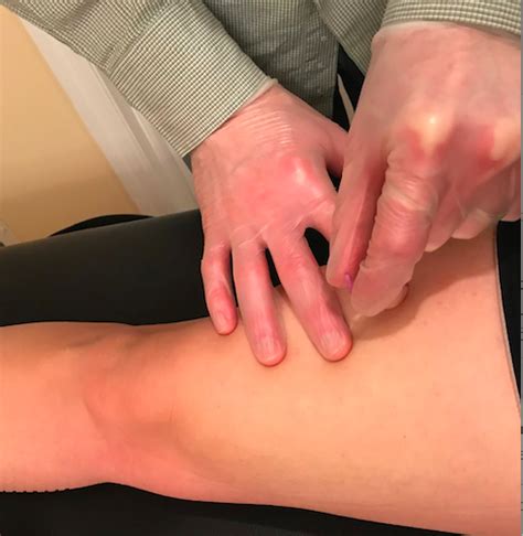 What Is This BUZZ Around Trigger Point Dry Needling Will It Help My Pain