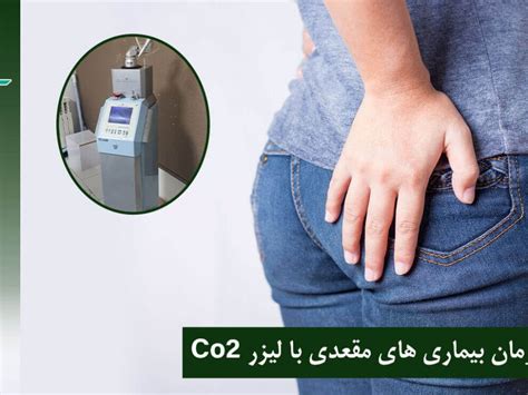 درمان بیماری های مقعدی با لیزر Co2