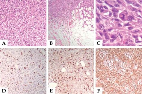 Undifferentiated Pleomorphic Sarcoma Anais Brasileiros De Dermatologia