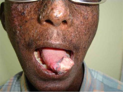 Carcinoma Of The Tip Of The Tongue In This 19year Old With Xeroderma