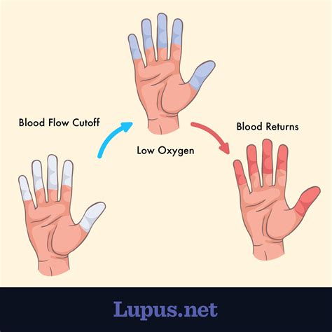 How Are Raynauds And Lupus Related
