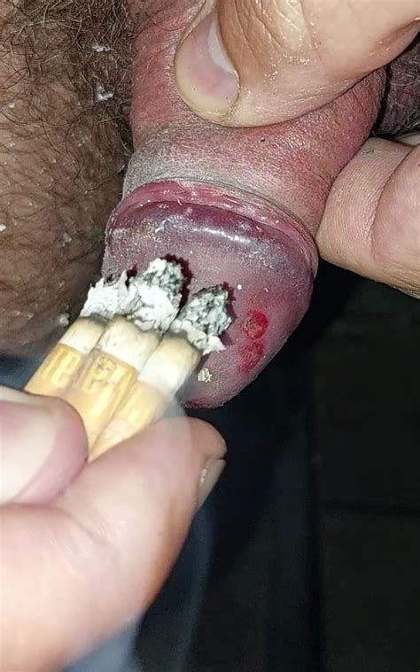 Stubbing 3 Cigarettes On My Cockhead At The Same Time