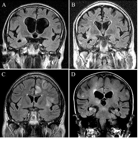 Table 1 From Neuroimaging Features In Subacute Encephalopathy With
