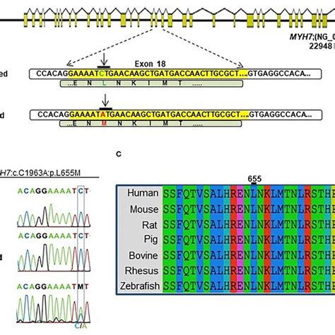 Identification Of The Myh7 Heterozygous Variant In The Selected Iranian