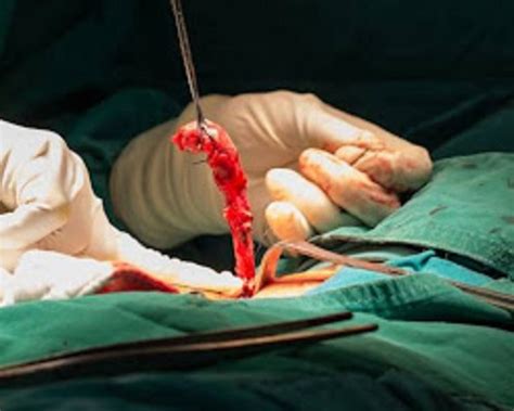 Appendicitis And Appendectomy You Need To Know Surgery Planned
