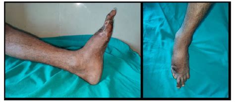 Clinical Image Showing Left Foot Post Radical Excision Of The Download Scientific Diagram