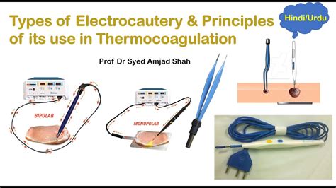 Types Of Electrocautery And Principles Of Its Use In Thermocoagulation