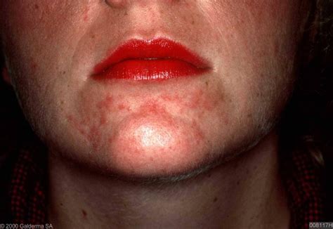 Dermatitis Perioralis