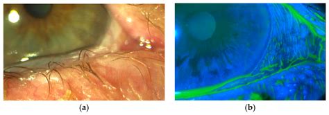 The Location Of Conjunctivochalasis And Its Clinical Correlation With