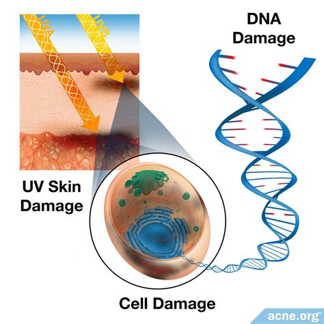 What S The Difference Between UVA And UVB Rays Acne Org