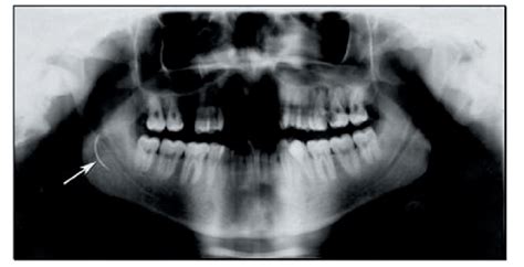 Repeated Panoramic X Ray Showing The Needle In The Tonsillar Region