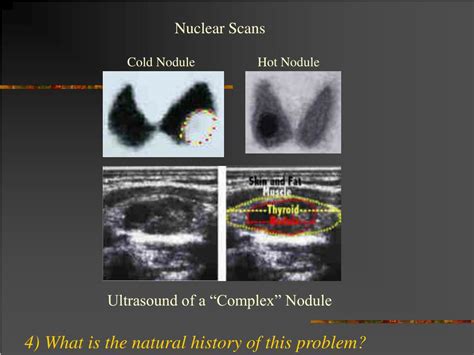 Ppt Subclinical Thyroid Dysfunction A Conundrum Powerpoint Presentation Id 3338378
