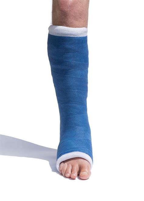 How To Cover A Leg Cast At Jamie Gibb Blog