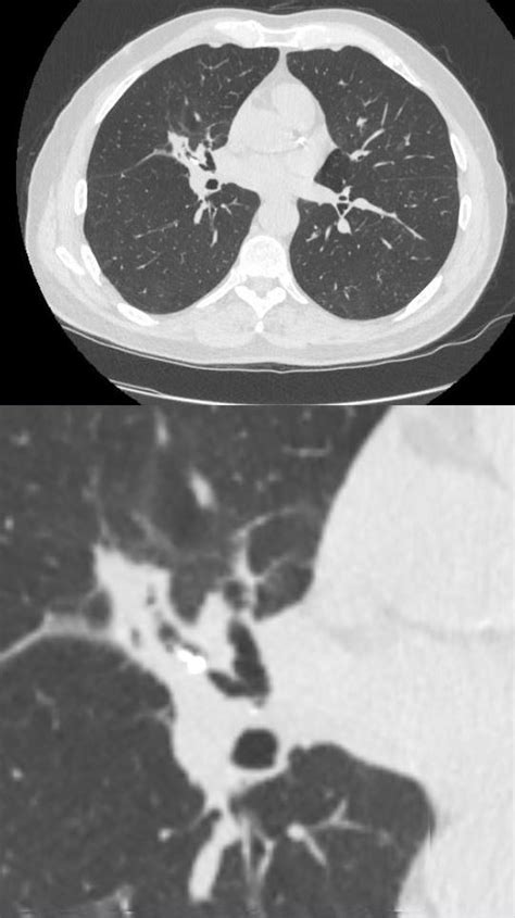 000 Broncholith The Common Vein
