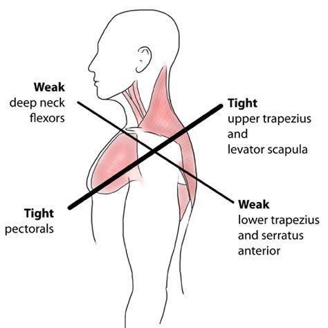 Upper Cross Syndrome Symptoms Causes And Treatment