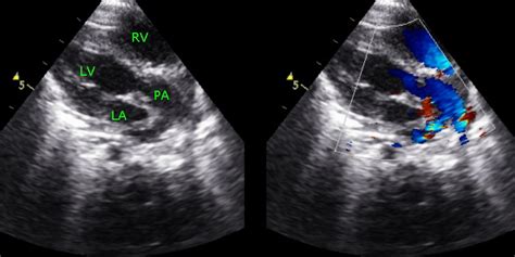 Modified Plax View In Tga Transposition Of Great Arteries