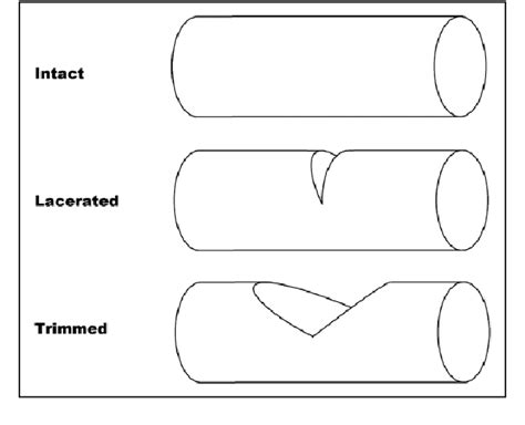 Figure 1 From Effect Of Triggering And Entrapment On Tendon Gliding Properties Following Digital