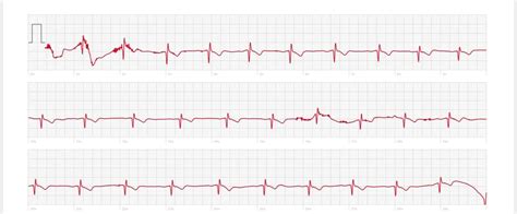 Is This A Normal Ekg Rreadmyecg