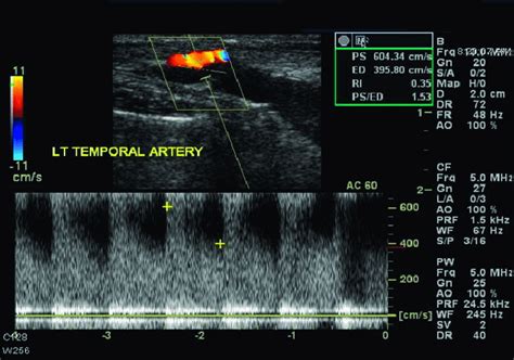 High Velocity Of Avf In Left Temporal Artery Download Scientific Diagram