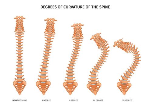 Degenerative And Rheumatologic Spinal Disorders Coupoly