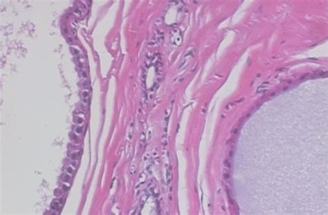 Github Avinassh Breast Cancer Prediction