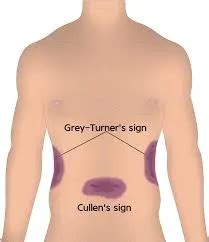 What Is Grey Turners Sign