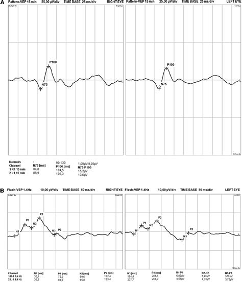 An Exemplary Trace Of Baseline Pattern Vep A And Flash Vep B