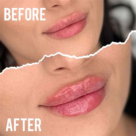 კოსმეტოლოგი ფილერი ტუჩის ფილერი ცხვირის ფილერი Lipstbilisi • Instagram Photos And Videos