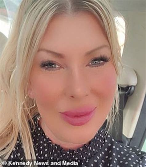 Cô dâu xinh đẹp phải hoãn đám cưới gấp vì tiêm filler hư đôi môi