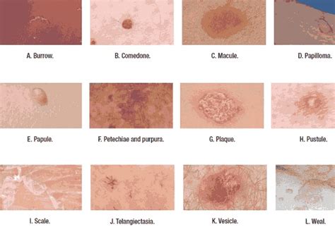 Skin Lesions