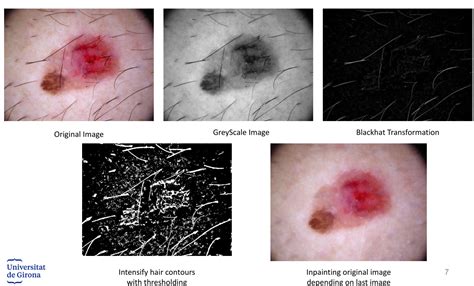 Github Arozhada Skin Lesions Classification Classification Of The Ham Dataset On Skin