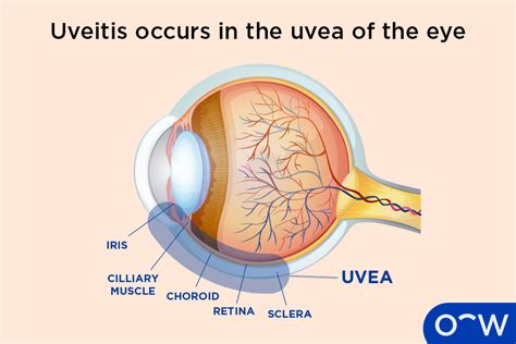 Uveitis Causes Types Symptoms Headache Qizr