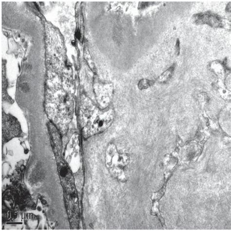 Renal Pathological Features Of Electron Microscopy A Massive Download Scientific Diagram