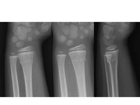 The A D D E D Torus Fracture A K A Buckle Fracture