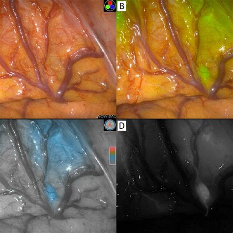 Intraoperative Fluorescence Imaging During Sentinel Node Navigation