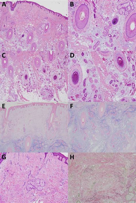 Slight Increase In Sebaceous Lobules And Thickening Of Dermis Increase