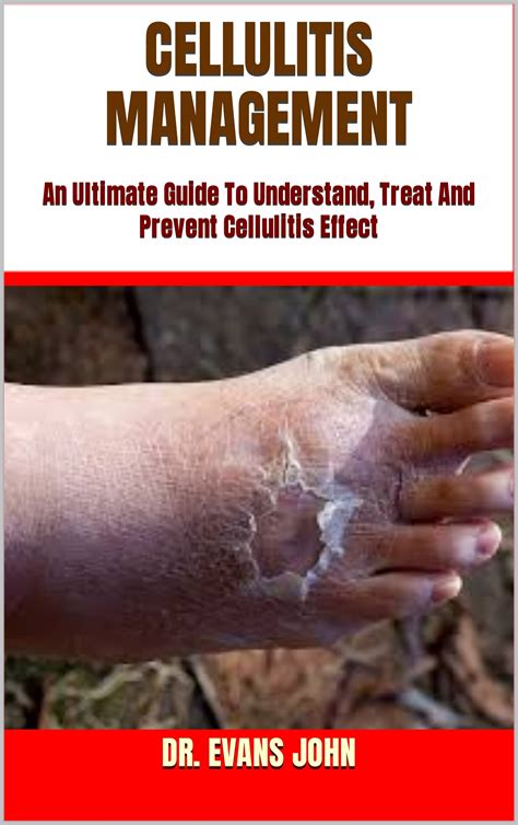 Buy Cellulitis Management An Ultimate Guide To Understand Treat And