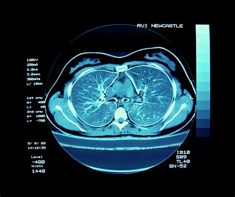 What Is A Non Contrast Lung Ct Scan At Brodie Hannell Blog