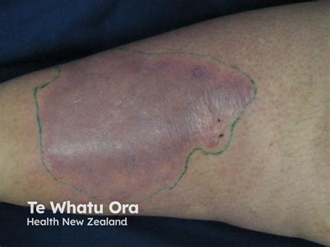 Lipodermatosclerosis Images