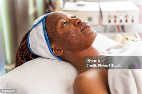 얼굴에 여드름 흉터가 있는 민족 젊은 여성의 측면 모습 여드름에 대한 스톡 사진 및 기타 이미지 여드름 피부과 전문의 흑인 민족 Istock