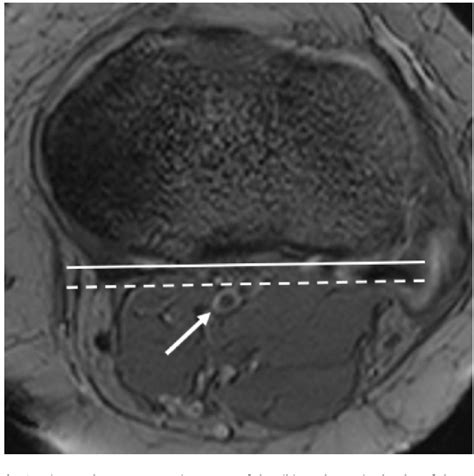 Figure 1 From Analysis Of The Running Position Of The Popliteal Artery And Branching Level Of