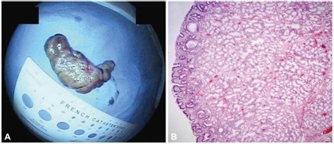 Pathologic Findings A Gross Finding Right After The Endoscopic Download Scientific Diagram
