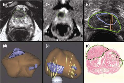 Magnetic Resonance Imaging Mri And Ultrasound Fusion For Targeted Download Scientific Diagram