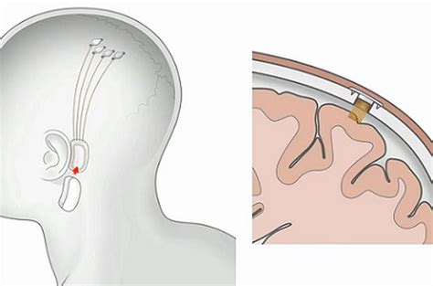 Technology AI Neuralink Elon Musk And Human Brain Machine Interface